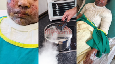 Wanita Ini Melecur Teruk, Pressure Cooker Tiba-tiba Meletup, Sup ...